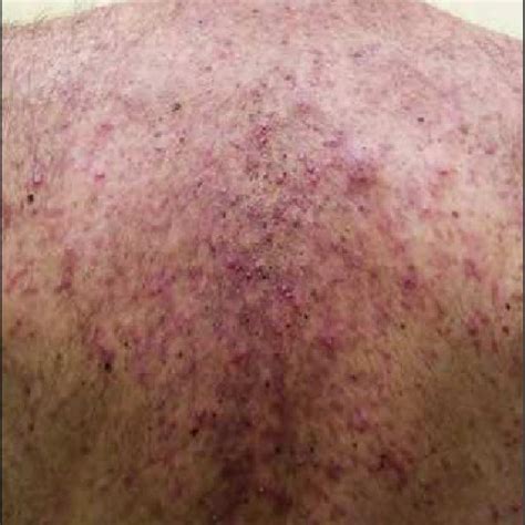 66 Year Old Male Patients Acneiform Rash After 2 Nd Cycle 4 Th Week
