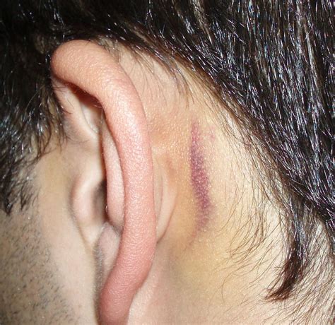 Bruise Behind My Ear Hair Restoration Questions And Answers Hair