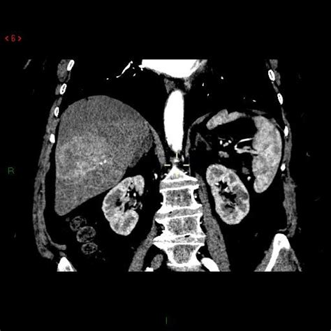 Tace Debdox Lifepearl Terumo Interventionalradiology