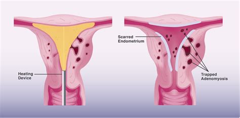 Why Endometrial Ablation For Adenomyosis Makes Pain Worse