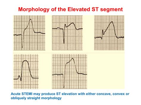 St Segment In Ecg St Elevation And St Depression Pptx