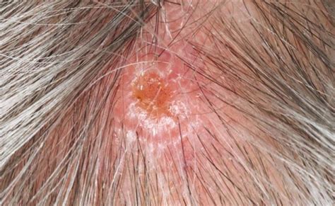 Risk For Basal Squamous Cell Carcinoma Linked To Hydrochlorothiazide