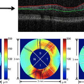 Example Of OCT B Scan Image With Segmented Boundaries And Feature Download Scientific Diagram