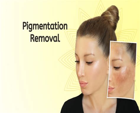 Pigmentation Removal Tvak Laser Clinic