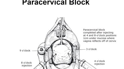 IUDs Management Of Challenging Insertions YouTube
