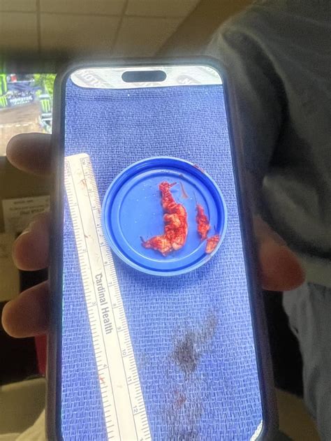 Laminectomy Rsciatica