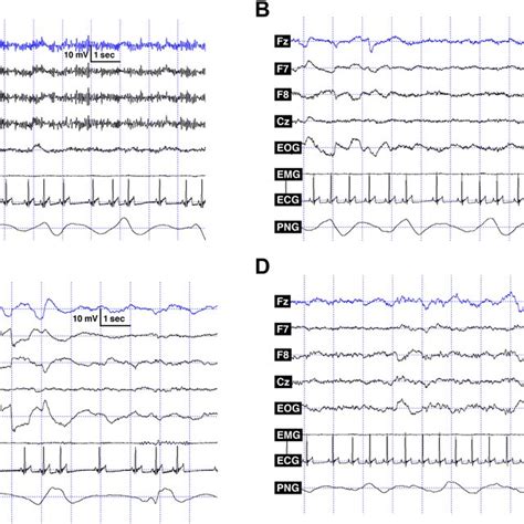 A Polysomnography Data Showing The Recorded Signals EEG Channels Download Scientific Diagram