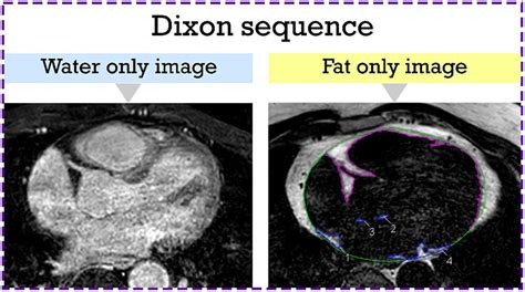 Epicardial Adipose Tissue Segmentation From The Axial Dixon Mri Download Scientific Diagram