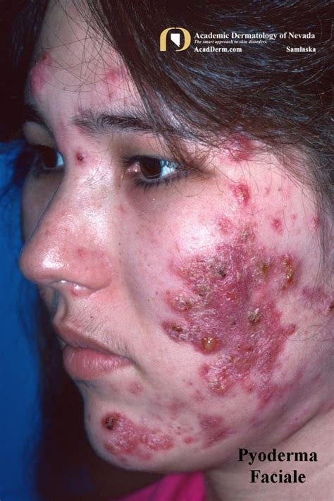 Complex Acne Disorders Pyoderma Faciale Academic Dermatology Of Nevada