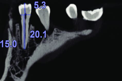 Measurement By Cone Beam Computed Tomography Download Scientific Diagram