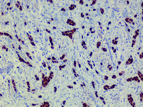 Islands Of P63 Stained Atypical Squamoid Cells In The Dermis 3 200 Download Scientific Diagram