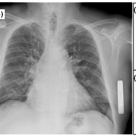 Leadless Pacemaker Implantation On The Left Of The Delivery System In Download Scientific