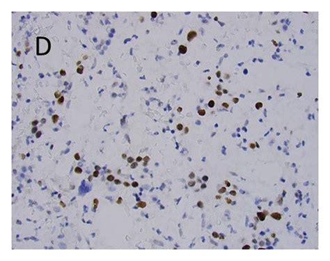 Immunohistochemistry Stained Bone Marrow Biopsy Sections Showing Download Scientific Diagram