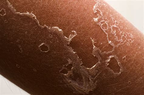 Ask The Experts Blisters