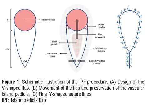 Repair Of A Medial Cheek Skin Defect With An Island Pedicle Flap