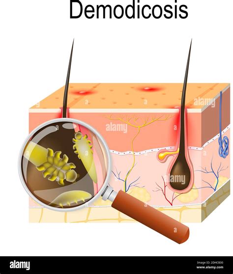 Scabies Under Magnifying Glass