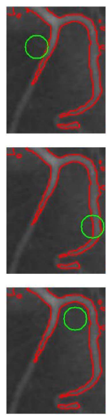 Segmentation Results On An X Ray Vessel Image By Cv A Rsf B L Download Scientific