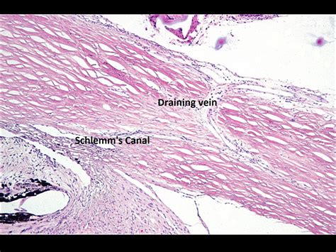 Moran Core Glaucoma Anterior Chamber