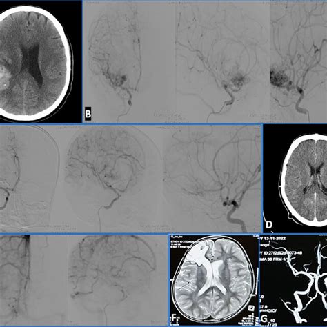 A Ncct Non Contrast Computed Tomography Of Head Of A 17 Years Old Download Scientific Diagram