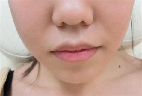 クリニック施術紹介ブログ 【小顔】表参道美容外科クリニックの小顔治療メニュー♡ 表参道美容外科クリニック｜表参道駅b2出口徒歩0分