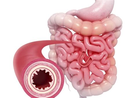 Καρκίνος Λεπτού Εντέρου Δρ Εμμανουήλ Σεβαστιάδης