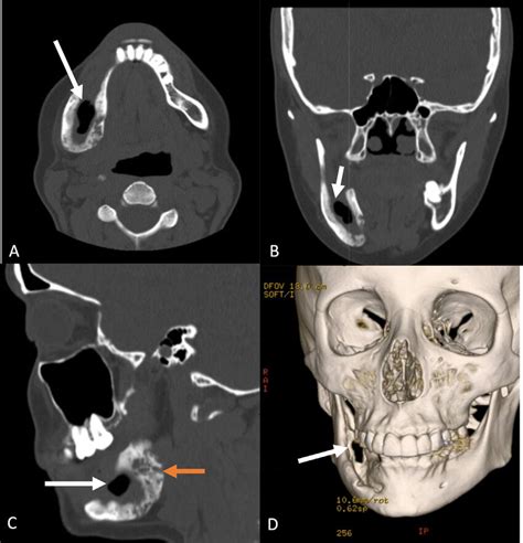Noncontrast Ct In Bone Window A C And Volume Rendering Download Scientific Diagram