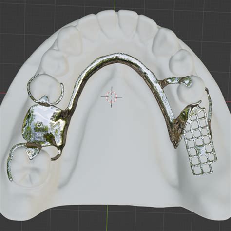 🦷 Prosthodontics Kennedy Class Ii Mod 1 Removable Partial Dentures Lower Jaw・ Stl File For 3d