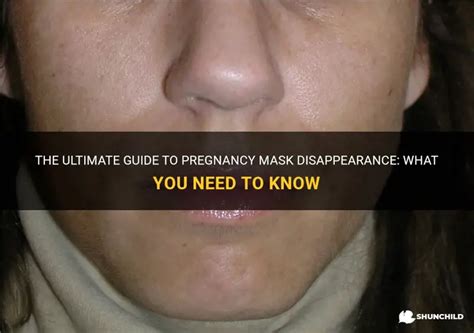 The Ultimate Guide To Pregnancy Mask Disappearance What You Need To