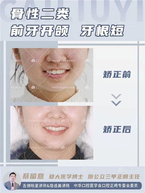 郑州牙齿矫正正畸有年龄限制吗？30还可以整牙吗？ 知乎