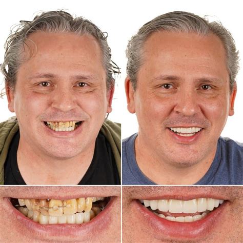 Dental Implants Before And After Transformations Atl Dental Implants