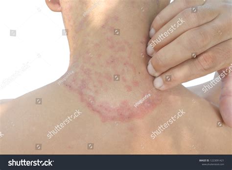 Fungal Rash On Neck
