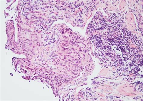 Ureter Biopsy 44f With Moderate To Severe Hydronephrosis No Stones