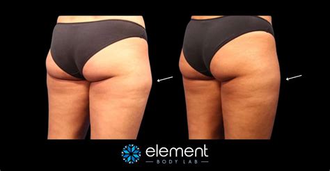 Getting Rid Of Cellulite Natural Remedies For Smoother Legs