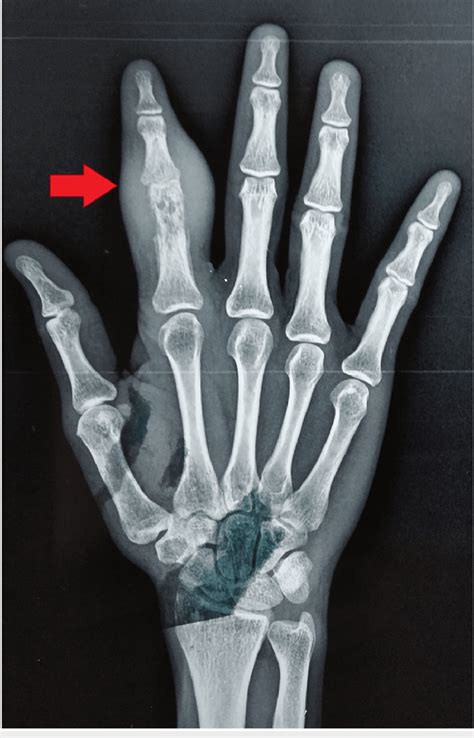 Radiograph Of The Right Hand P A View Showing Soft Tissue Swelling