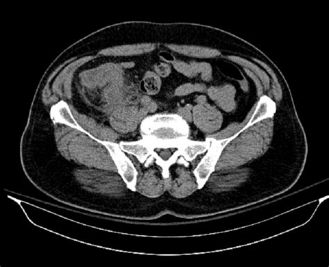 Appendicitis Simply Radiology Imaging For Suspected Appendicitis