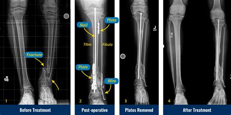 Tibia And Fibula Fracture Surgery