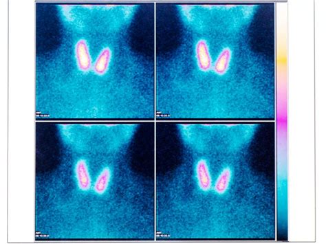 Thyroid Scan Purpose Procedure And Results