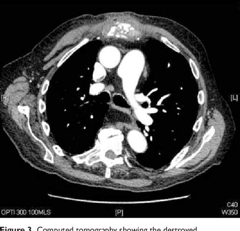 Figure 1 From Manubriosternal Subluxation Dislocation Can Lead To Manubriosternal Septic