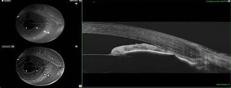 Oct Of The Anterior Segment Of The Eye 84 Year Old Patient Right Eye