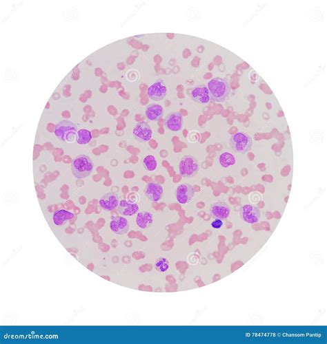 Microscopic View Of A Blood Smear From Leukemia Patient Showing Stock