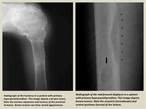 Hyperparathyroidism Archives