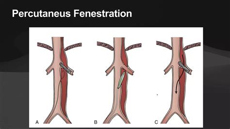 Aortic Dissection Pptx