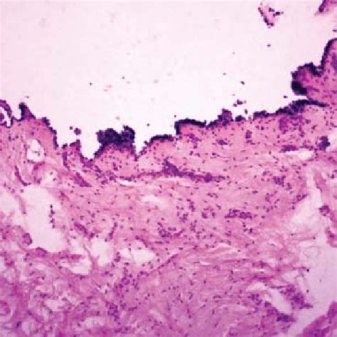 Pemphigus Vulgaris H And E Stained Section At 40× Showing Acantholytic Download Scientific