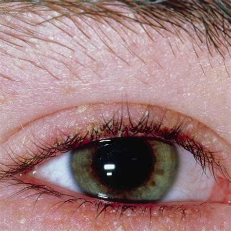 Anterior Blepharitis What Is Anterior Blepharitis Causes And Treatment Eye