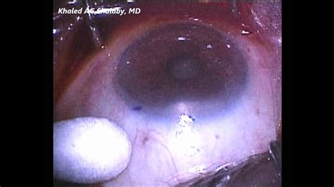 Intravitreal Lucentis Wmv Youtube