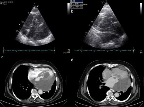 A And B Transthoracic Echocardiogram Modified 4 Chamber View Download Scientific Diagram