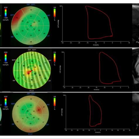 Myocardial Work Parameters According To Different Patterns Of