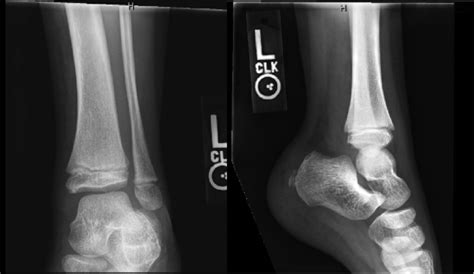 Ap And Lateral Radiographs Of The Left Ankle Reveal Soft Tissue Download Scientific Diagram