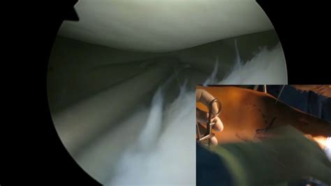 Repairing Posteromedial Meniscocapsular Separation Youtube