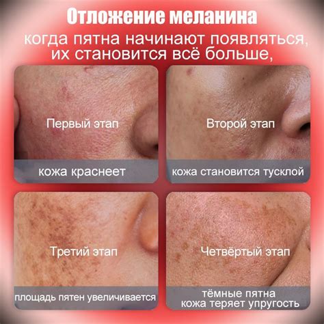 Крем для лица от Веснушек и Пигментных пятен 30г против пигментации отбеливающий для лица